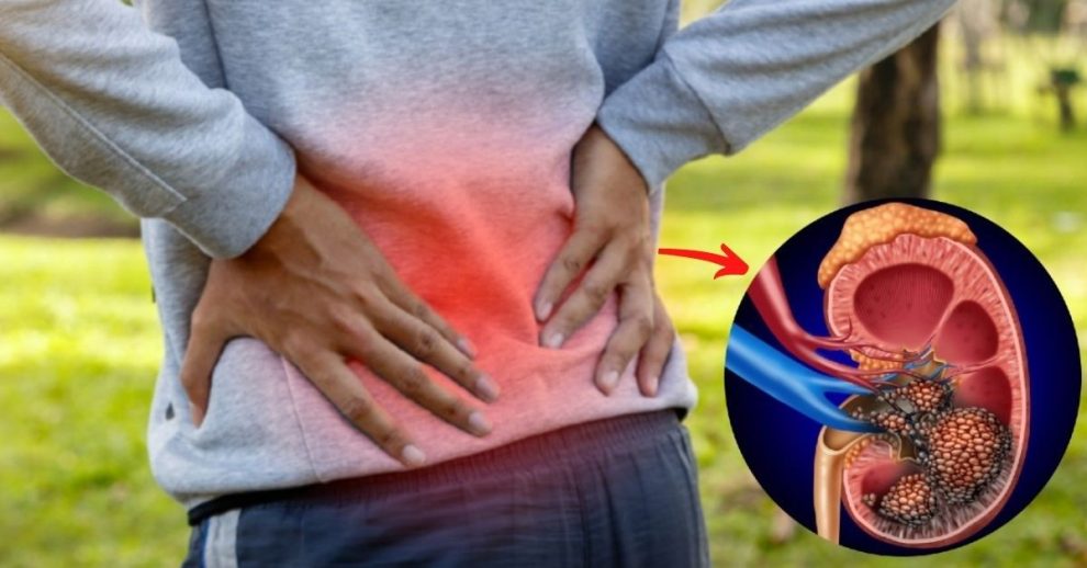 Síntomas que te ayudan a identificar el cáncer de riñón